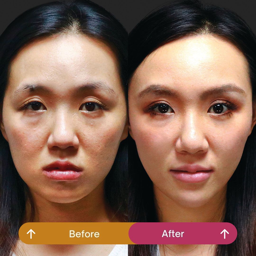 Ellansé Filler - Collagen Stimulator - Facial Rejuvenation