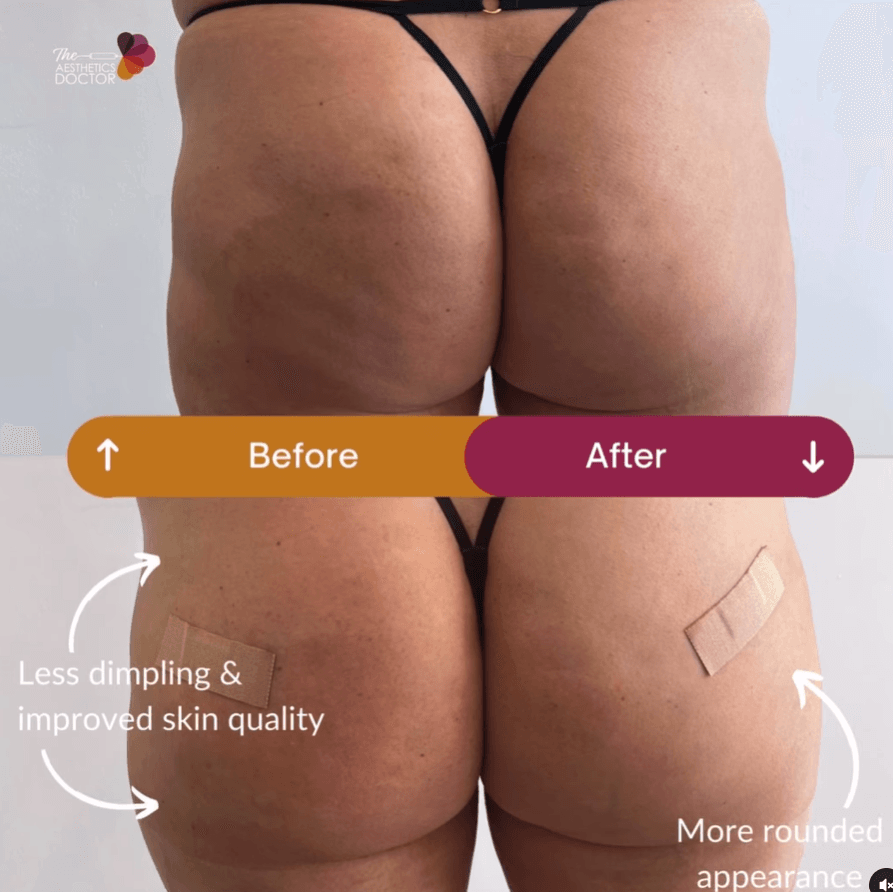 Non Surgical BBL, Prices and Before & Afters