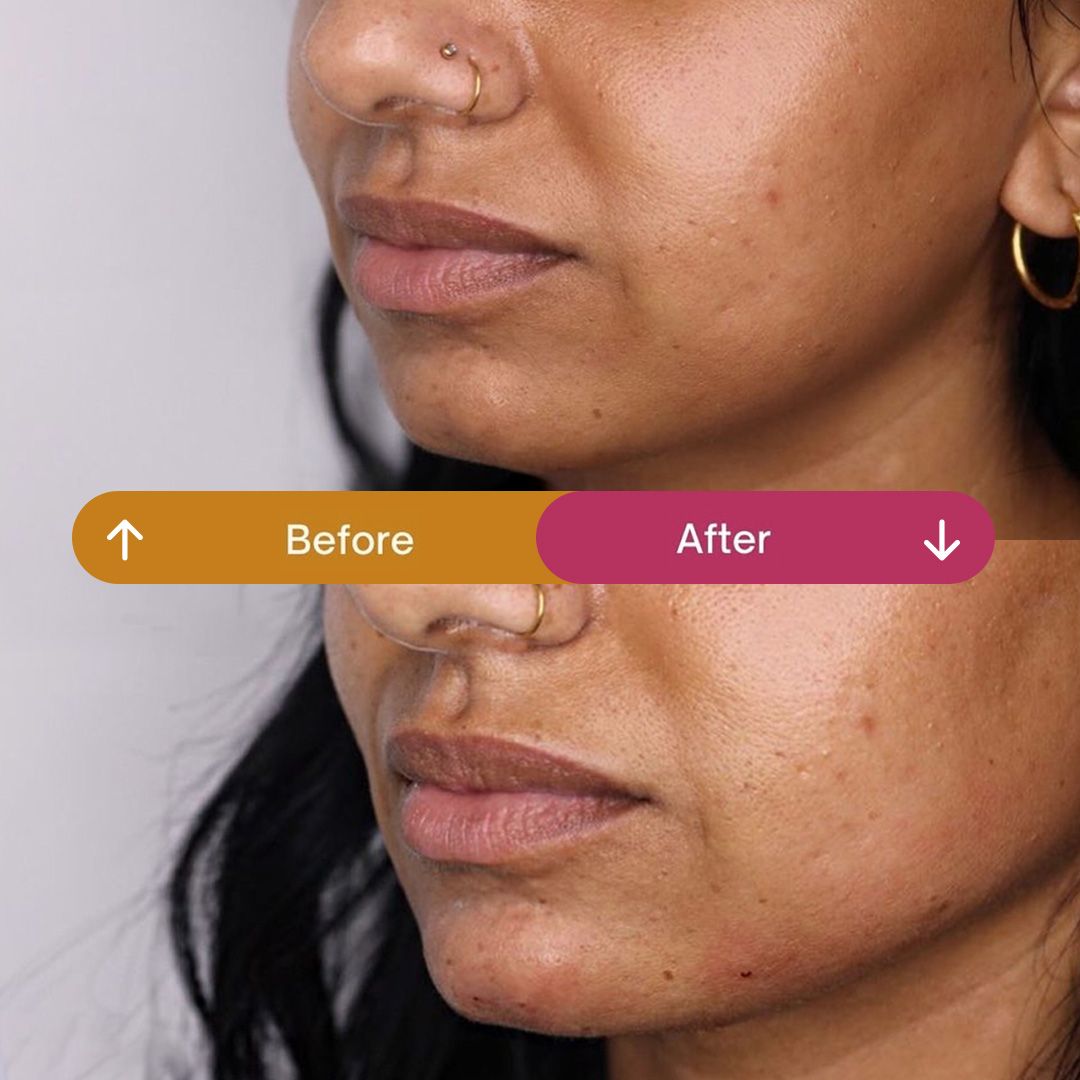MaiLi Filler - Premium Hyaluronic Acid Dermal Fillers