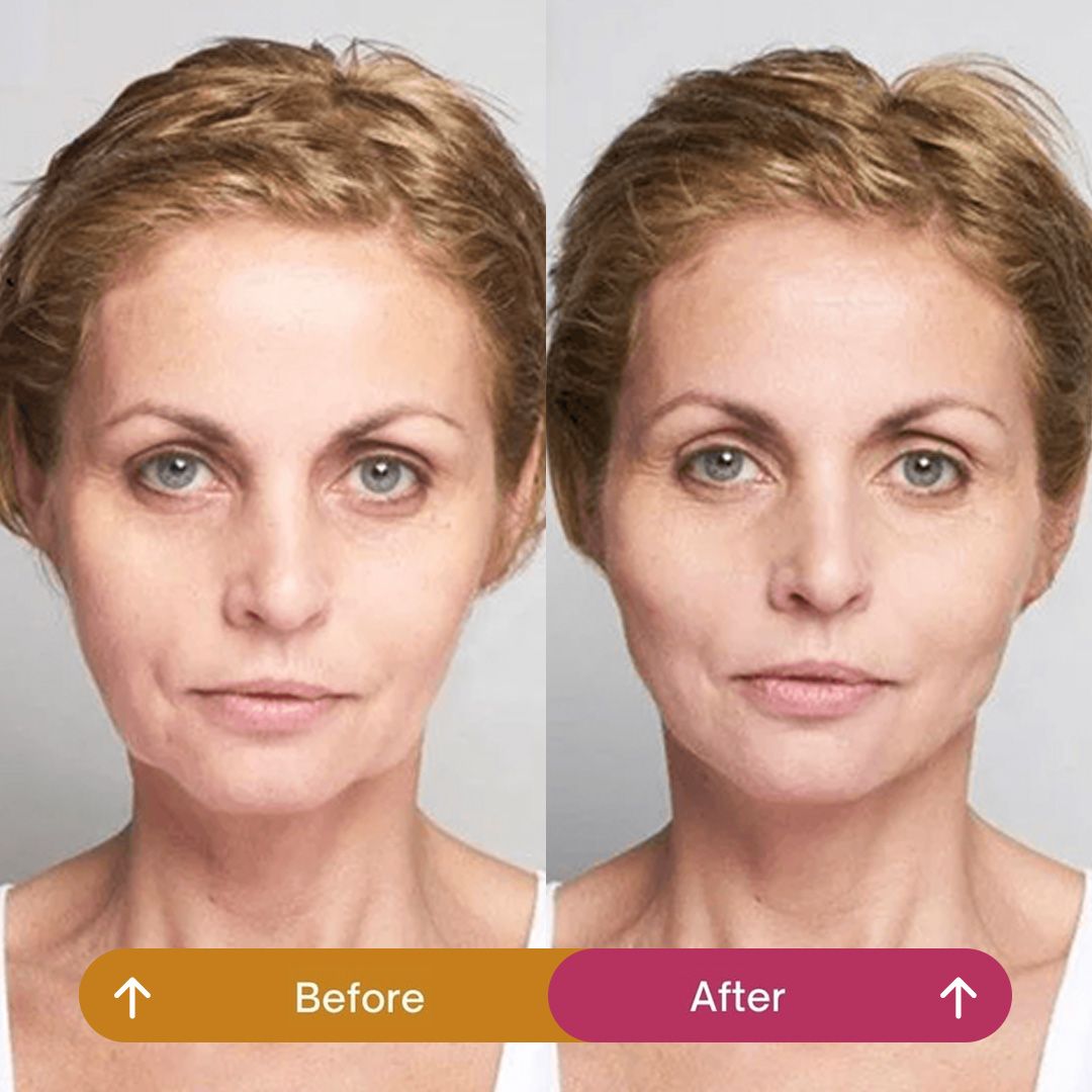 Non-Surgical Face Lift London – The Aesthetics Doctor