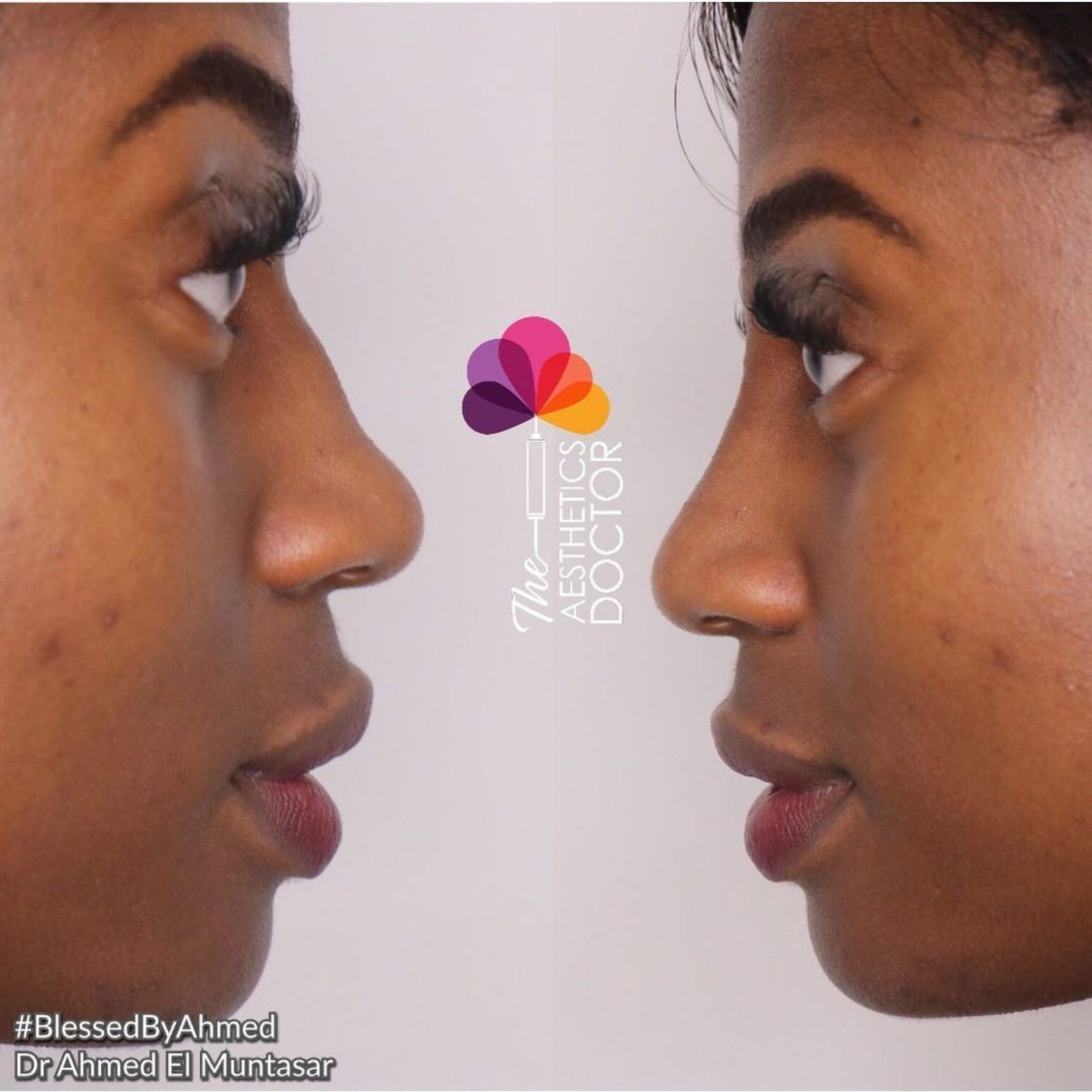 Nose Filler Before and After Photos - Non-Surgical Rhinoplasty London