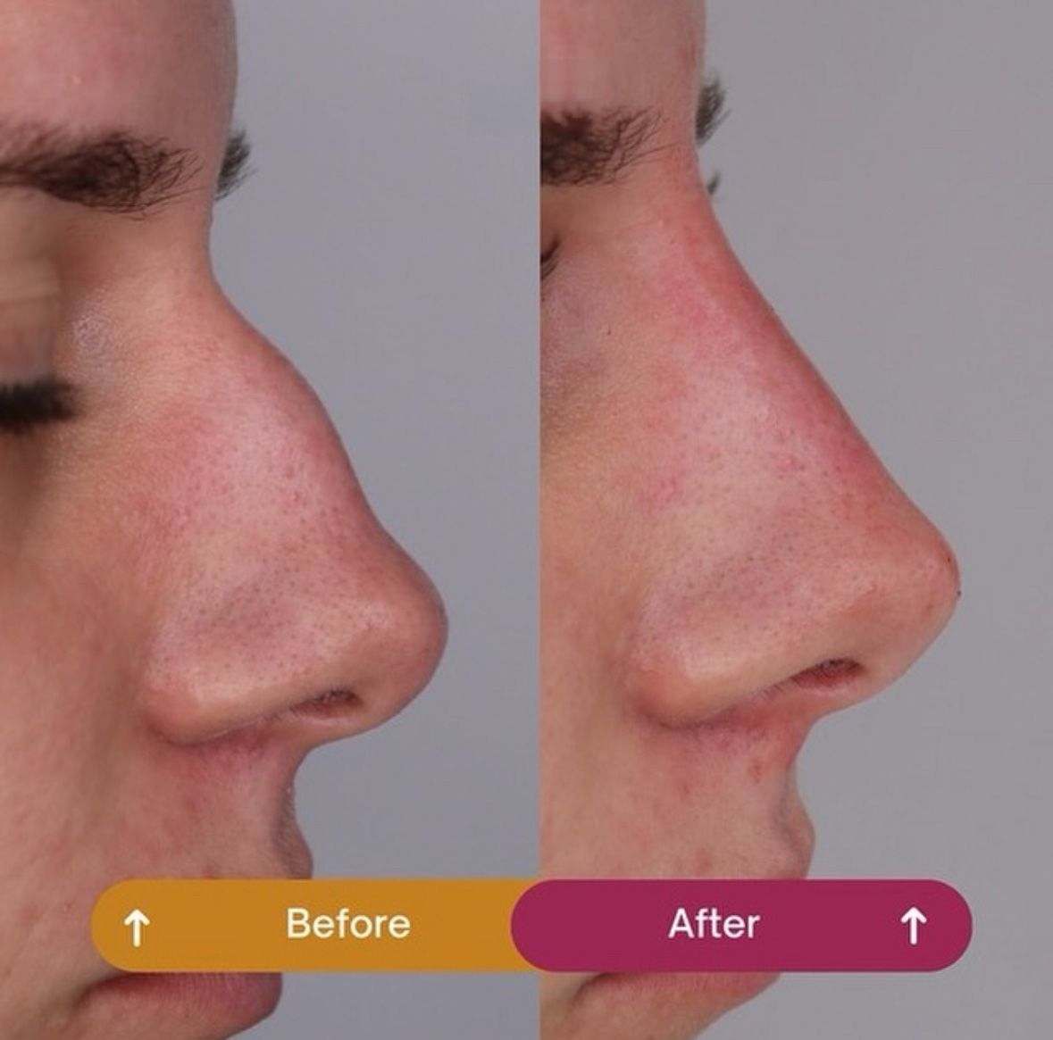 Nose Bump - Non-Surgical Rhinoplasty - The Aesthetics Doctor