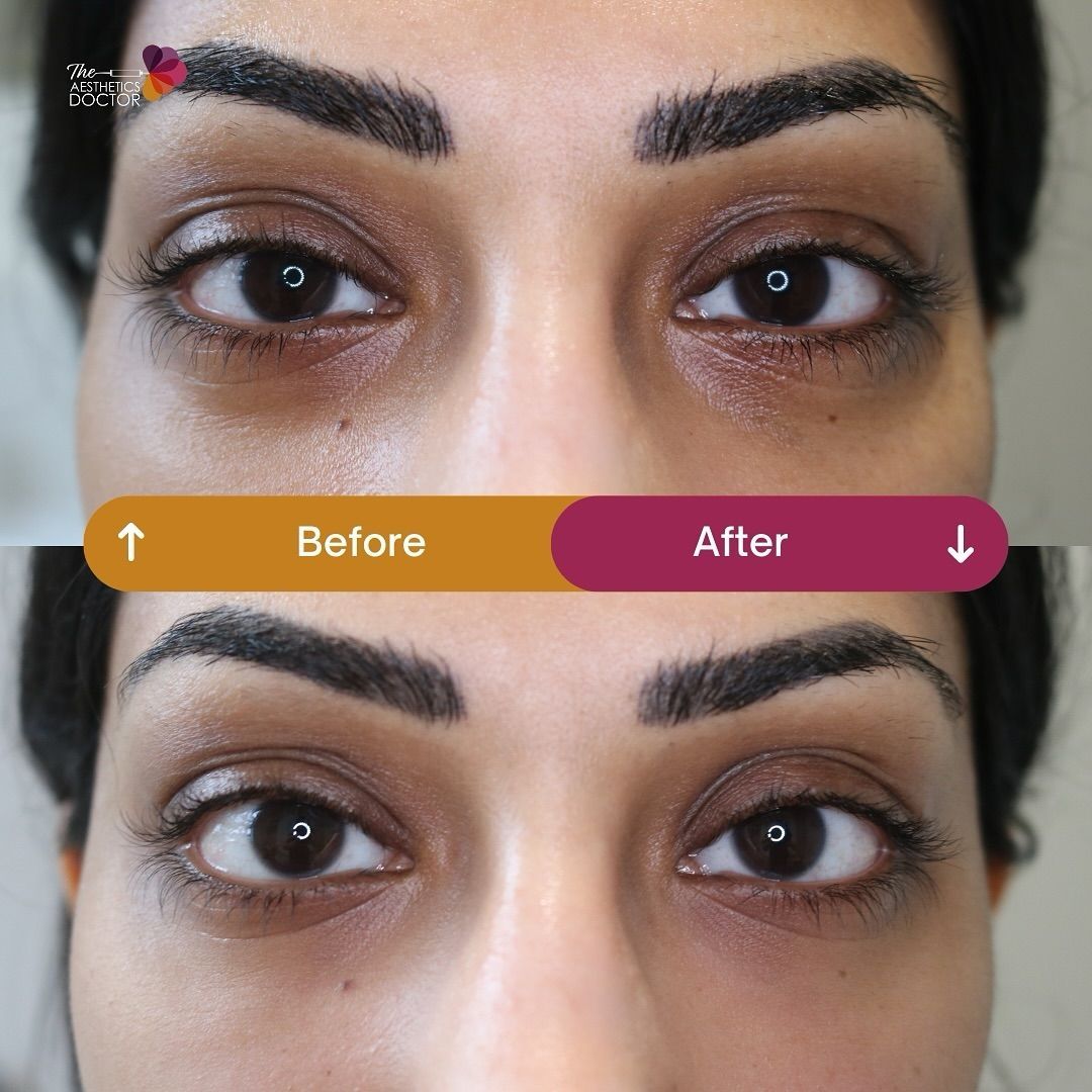 Tear Trough Filler Manchester – Filler treatments Cheshire