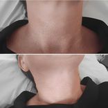 A Guide To Using Redensity 1 Skin Boosters - The Aesthetics Doctor